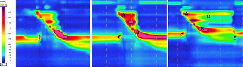 High-Resolution Manometry of Pharyngeal Swallow Pressure Events ...