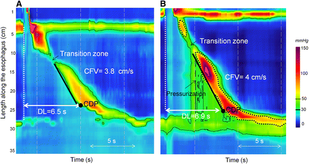 Distal Esophageal Spasm | SpringerLink