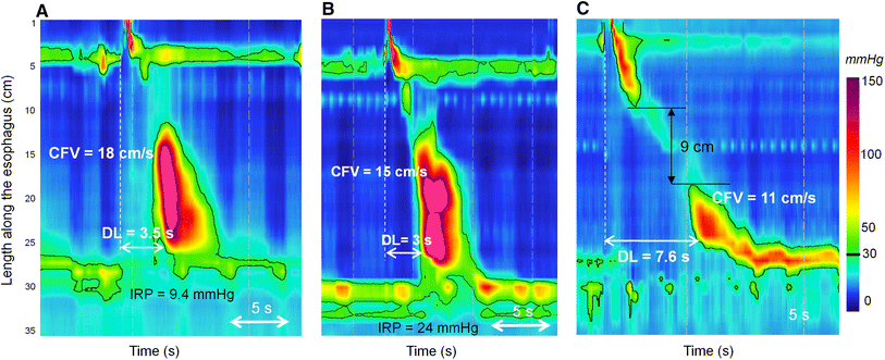 Distal Esophageal Spasm | SpringerLink