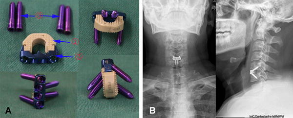 A Meta-Analysis of the Incidence of Patient-Reported Dysphagia After ...