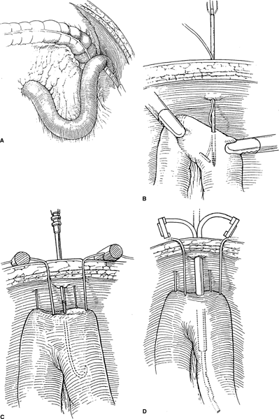 Laparoscopic feeding jejunostomy: A systematic review | SpringerLink