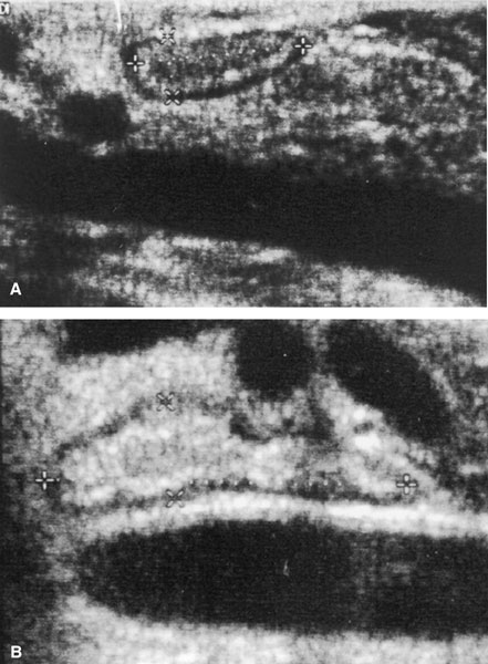 Suprapancreatic and periportal lymph nodes are normally larger than 1 ...