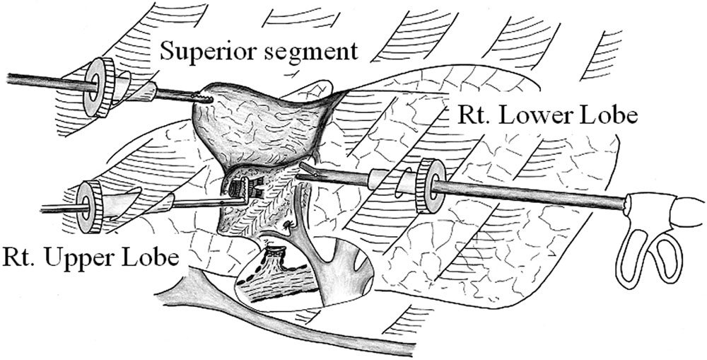 Video-assisted thoracoscopic surgery (VATS) segmentectomy for small ...