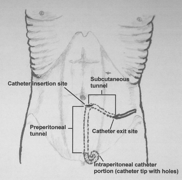 A new laparoscopic technique for the placement of a permanent ...