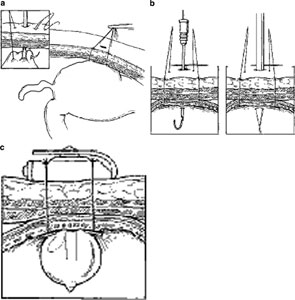 Laparoscopic cecostomy button placement for the management of fecal ...