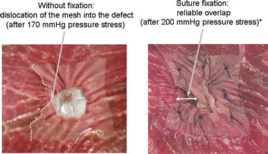 Biomechanical analyses of mesh fixation in TAPP and TEP hernia repair ...
