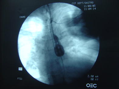 Percutaneous transesophageal gastrostomy (PTEG): a safe and effective ...