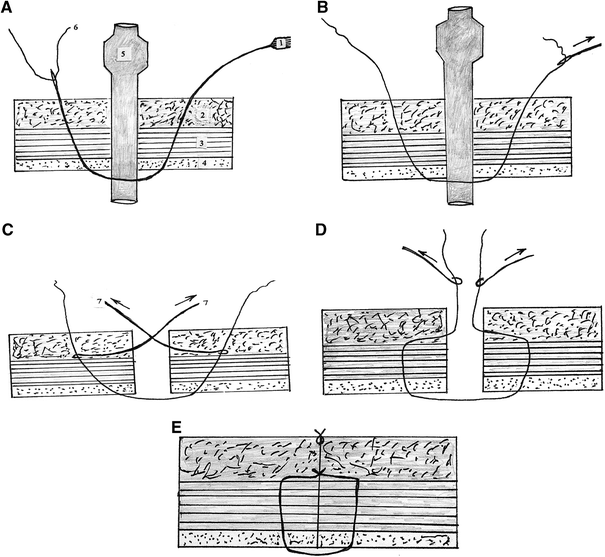 Anatomical closure of trocar site by using tip hole needle and ...