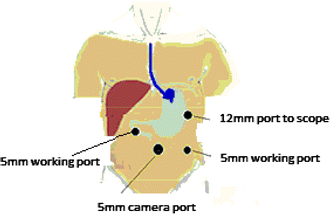 Laparoscopic transgastric endoscopic retrograde ...