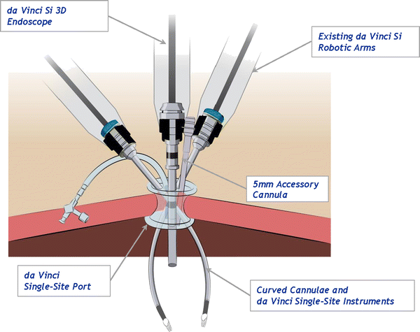 Single-site robotic cholecystectomy (SSRC) versus single-incision ...