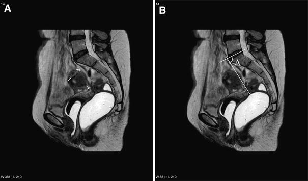 The optimal strategy for proximal mesh fixation during laparoscopic ...