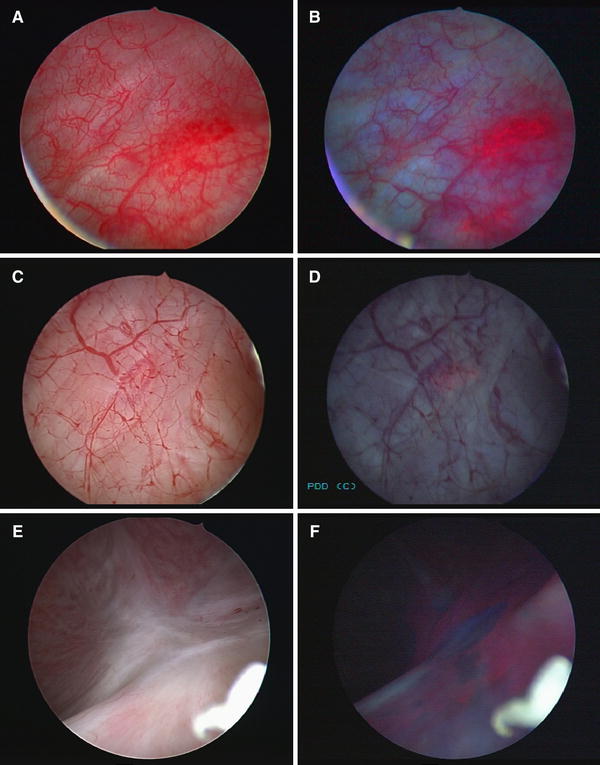 A comparison of hexaminolevulinate (Hexvix®) fluorescence cystoscopy ...