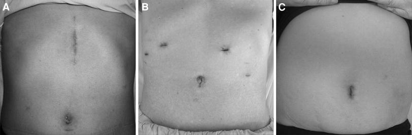 Hepatectomy based on the tumor hemodynamics for hepatocellular ...