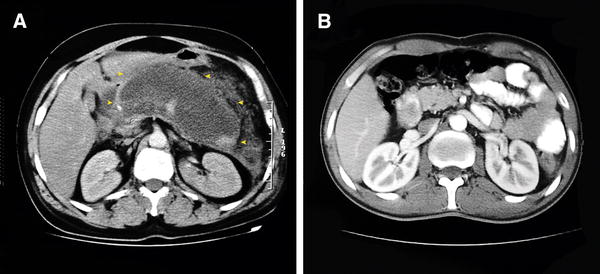 Transluminal retroperitoneal endoscopic necrosectomy with the use of ...