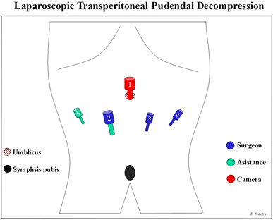 Laparoscopic pudendal nerve decompression and transposition combined ...