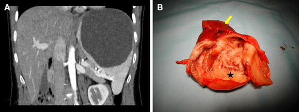 Laparoscopic partial splenectomy: a technical tip | SpringerLink