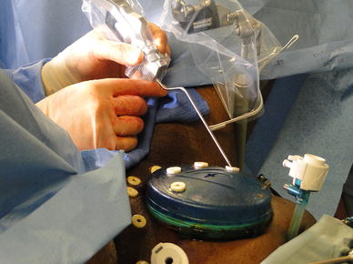 Stereotactic navigation for TAMIS-TME: opening the gateway to frameless ...