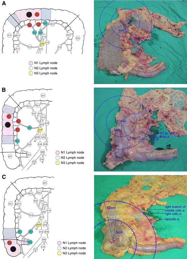 Long-term oncologic results of laparoscopic D3 lymphadenectomy with complete mesocolic excision ...