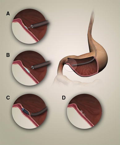 Assessment of the length of myotomy in peroral endoscopic pyloromyotomy ...