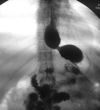 Residual fundus or neofundus after laparoscopic sleeve gastrectomy: is ...