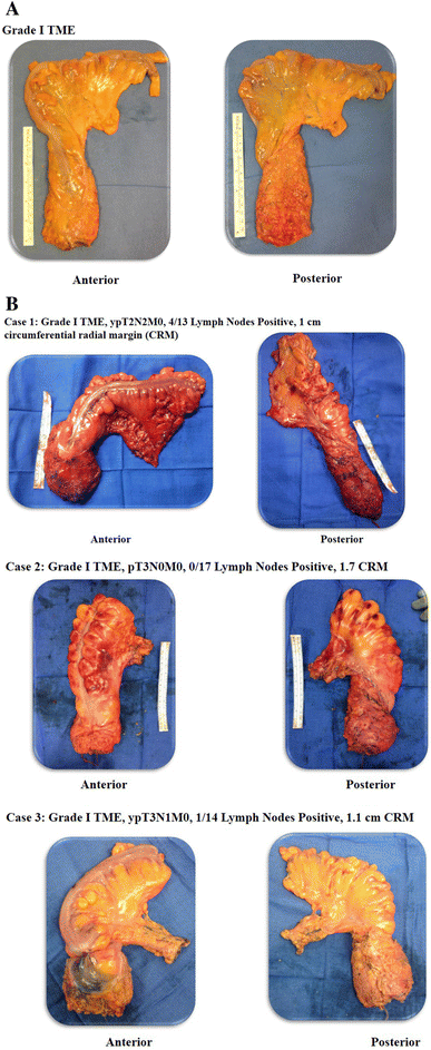 Transanal total mesorectal excision (taTME) for rectal cancer: a training pathway | SpringerLink