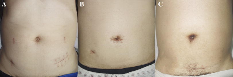 Assessment of treatment options for rectosigmoid cancer: single ...