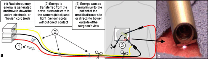 Stray energy transfer during endoscopy | SpringerLink
