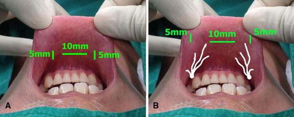 Transoral endoscopic thyroidectomy vestibular approach (TOETVA ...