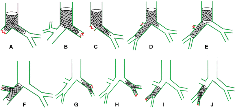 Customized airway stenting for bronchopleural fistula after pulmonary ...