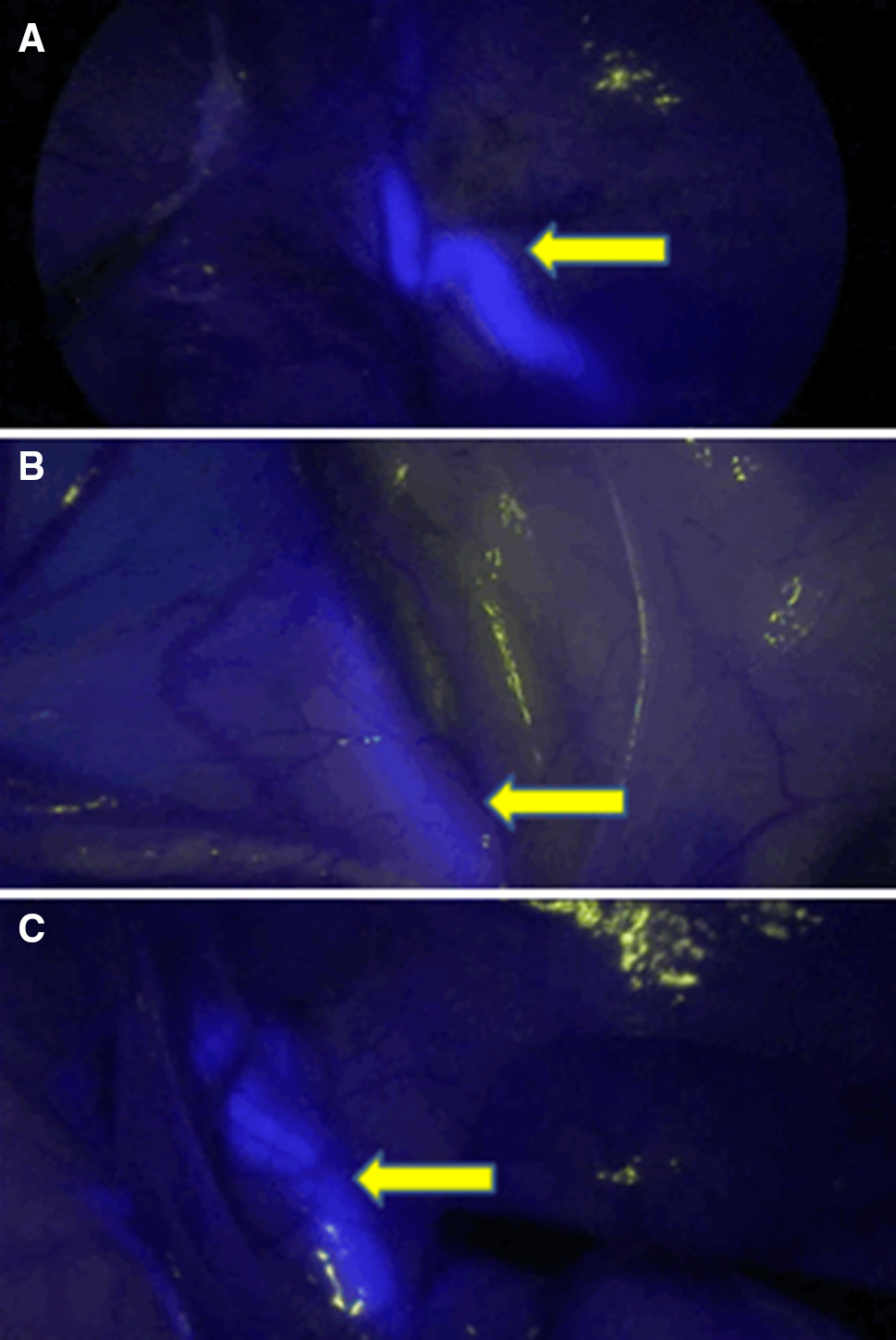 Near-infrared fluorescence laparoscopy of the ureter with three ...