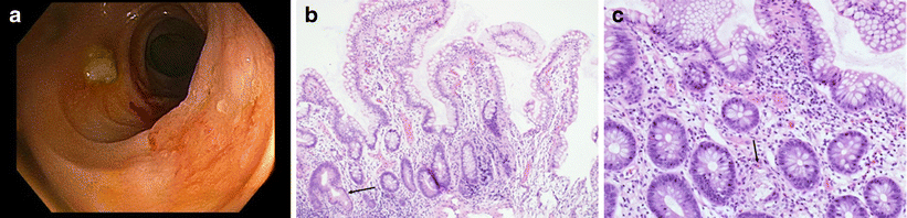 Diarrhea in a post-renal transplant child: Questions | SpringerLink