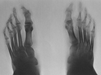 Vom Morbus Sudeck zum komplexen regionalen Schmerzsyndrom | SpringerLink