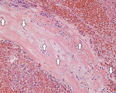 Subinvolution of placental bed vessels: case report and review of the ...