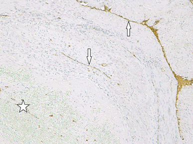 Subinvolution of placental bed vessels: case report and review of the ...