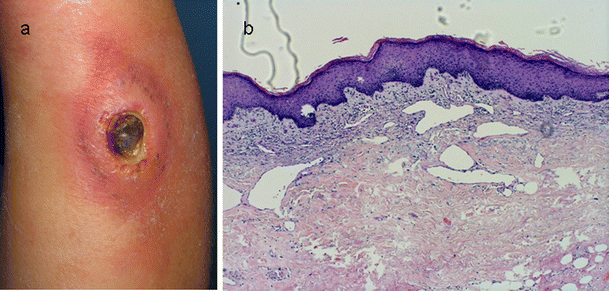 Outcome of chemotherapy extravasation in a large patient series using a ...