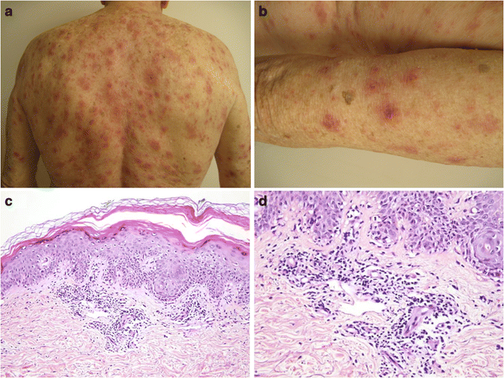 Ixazomib-induced cutaneous necrotizing vasculitis | SpringerLink