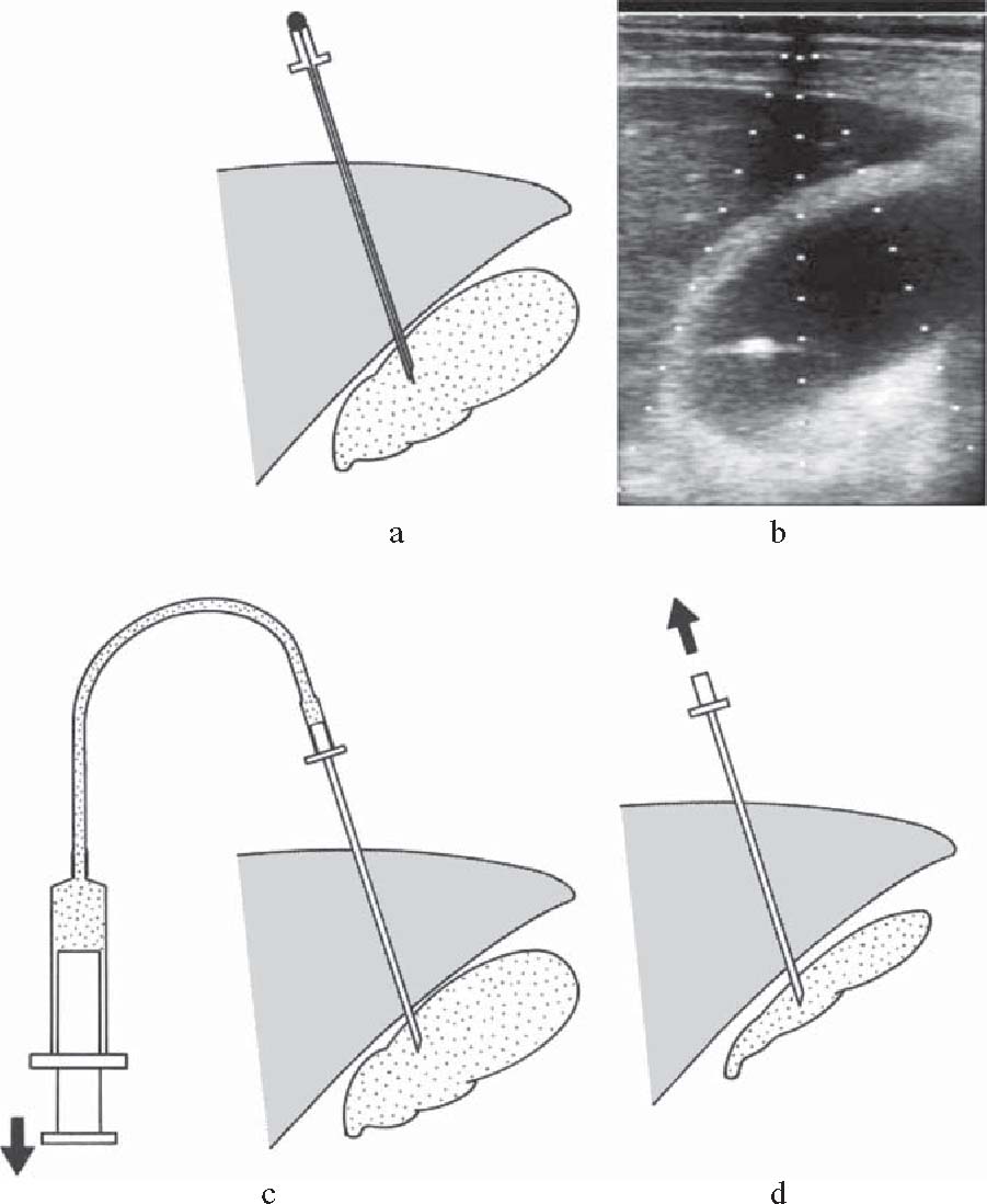 Techniques of biliary drainage for acute cholecystitis: Tokyo ...