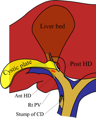 The critical view of safety in laparoscopic cholecystectomy is ...