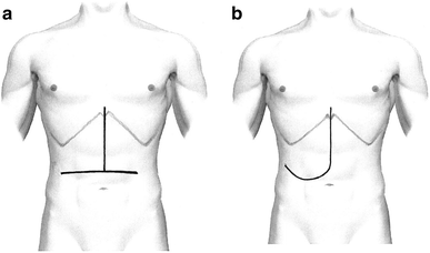 Segmentectomy of the liver | SpringerLink