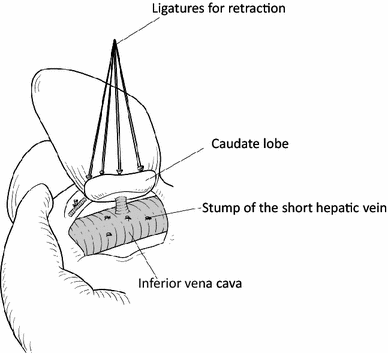 Left hepatectomy | SpringerLink