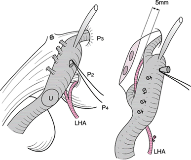 Right hepatectomy with resection of caudate lobe and extrahepatic bile duct for hilar ...