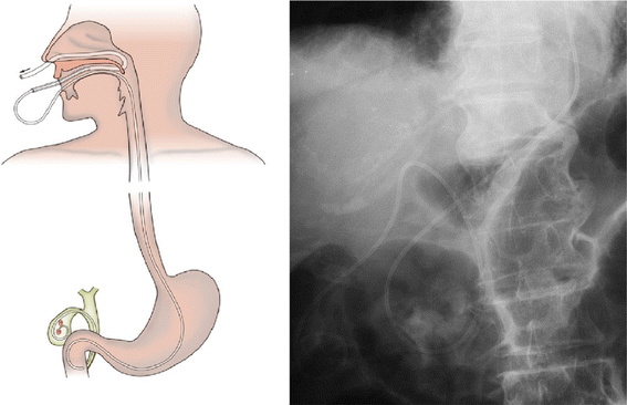 TG13 indications and techniques for gallbladder drainage in acute ...