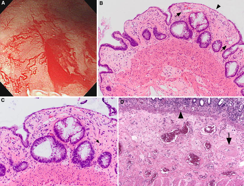 Biopsy interpretation of colonic biopsies when inflammatory bowel ...
