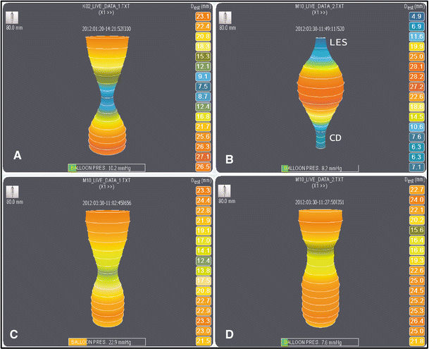 Functional lumen imaging of the gastrointestinal tract | SpringerLink