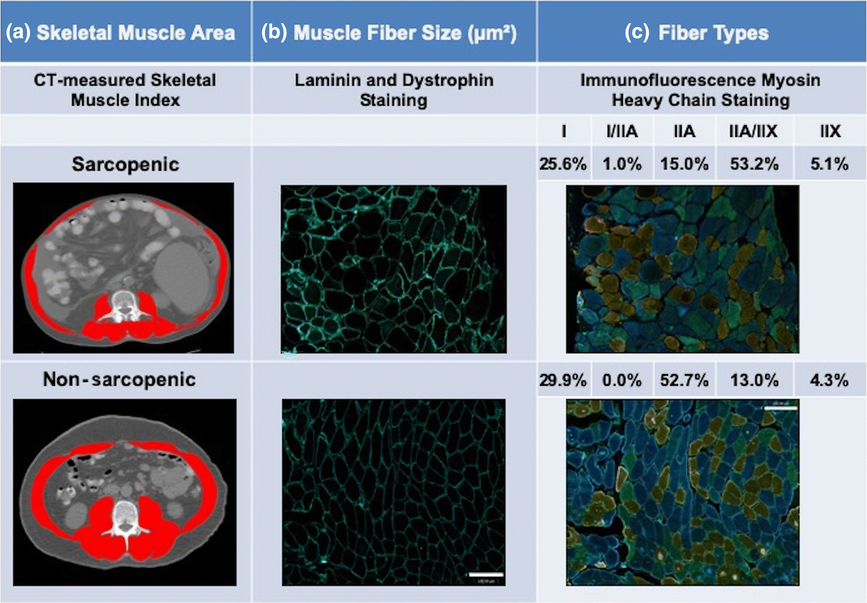 Sarcopenia in cirrhosis: from pathogenesis to interventions | SpringerLink