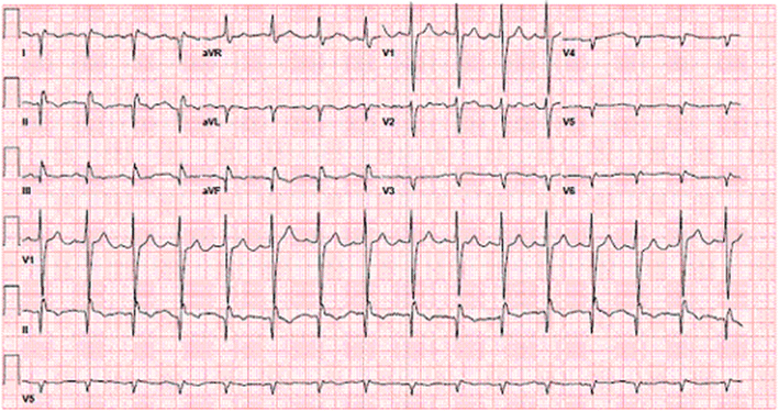 Perioperative implications and management of dextrocardia | SpringerLink