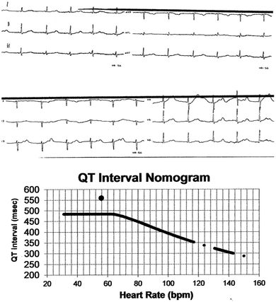 Acquired prolongation of QT interval as a risk factor for torsade de ...