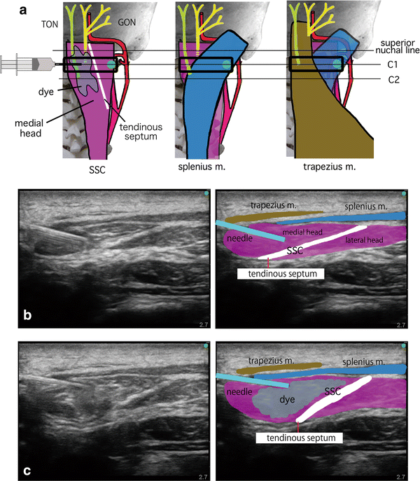 Anatomical basis for simultaneous block of greater and third occipital ...