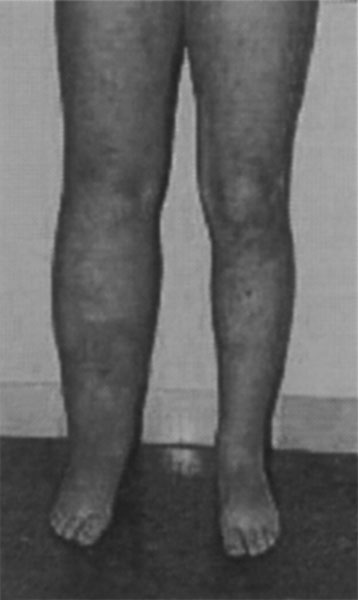 Lymphangiosarcoma in Congenital Familial Lymphedema (Milroy Disease ...