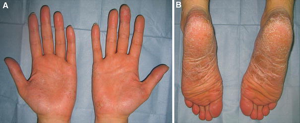 SAPHO syndrome associated spondylitis | SpringerLink